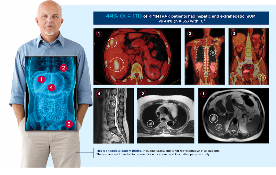 KIMMTRAK Efficacy Information - Discover Its Impact on mUM